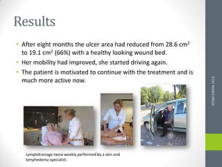 EWMA 2013 - Ep560 - LIVING WITH A VENOUS ARTERIAL LYMPHATIC ULCER FOR ...