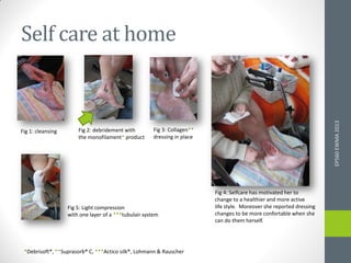 EWMA 2013 - Ep560 - LIVING WITH A VENOUS ARTERIAL LYMPHATIC ULCER FOR ...