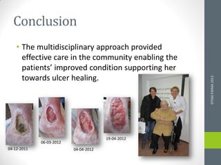 EWMA 2013 - Ep560 - LIVING WITH A VENOUS ARTERIAL LYMPHATIC ULCER FOR ...