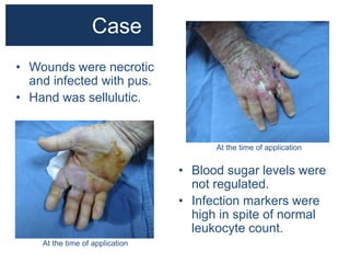 EWMA 2013 - Ep575 - A case of diabetic hand wound | PDF