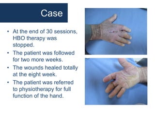 EWMA 2013 - Ep575 - A case of diabetic hand wound | PDF