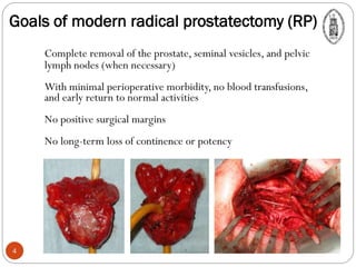 Surgery for localised, locally advanced and high risk prostate cancer | PPT