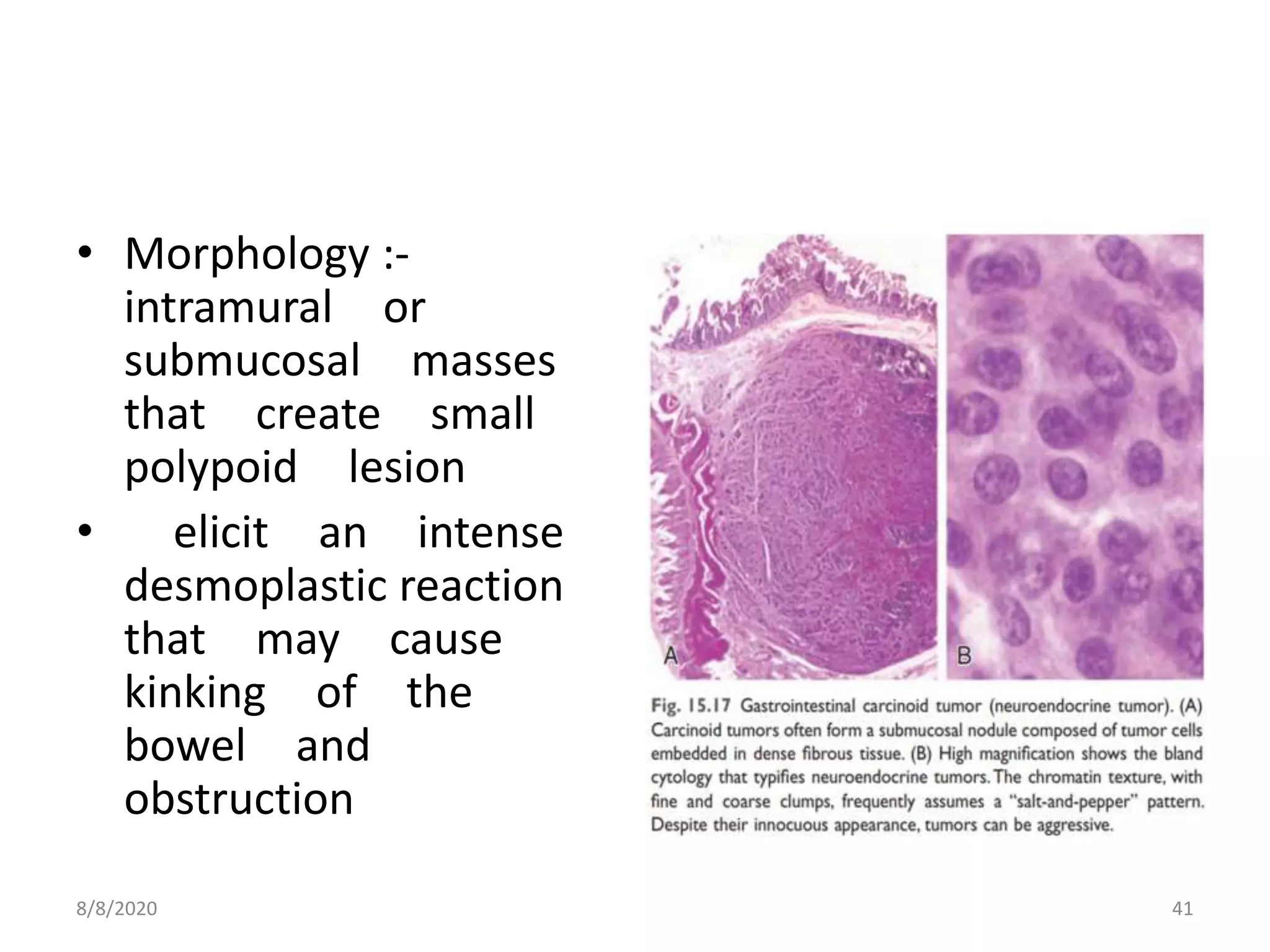 (E)pathology of gastric cancer | PPTX