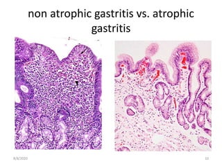 (E)pathology of gastric cancer | PPTX