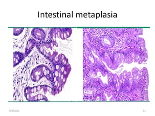(E)pathology of gastric cancer | PPTX