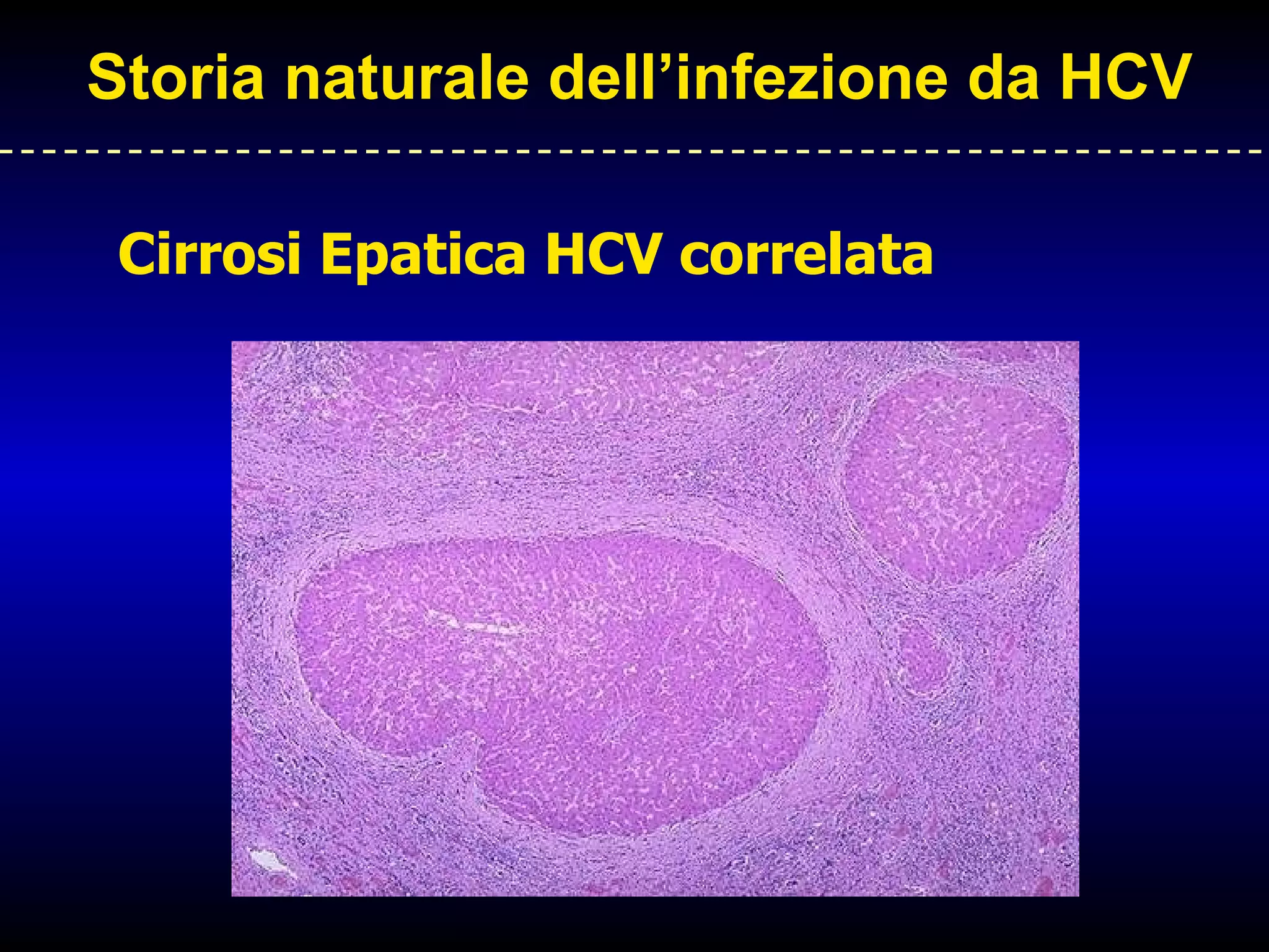 Epatite cronica HCV corelata storia naturale 2007 | PPT