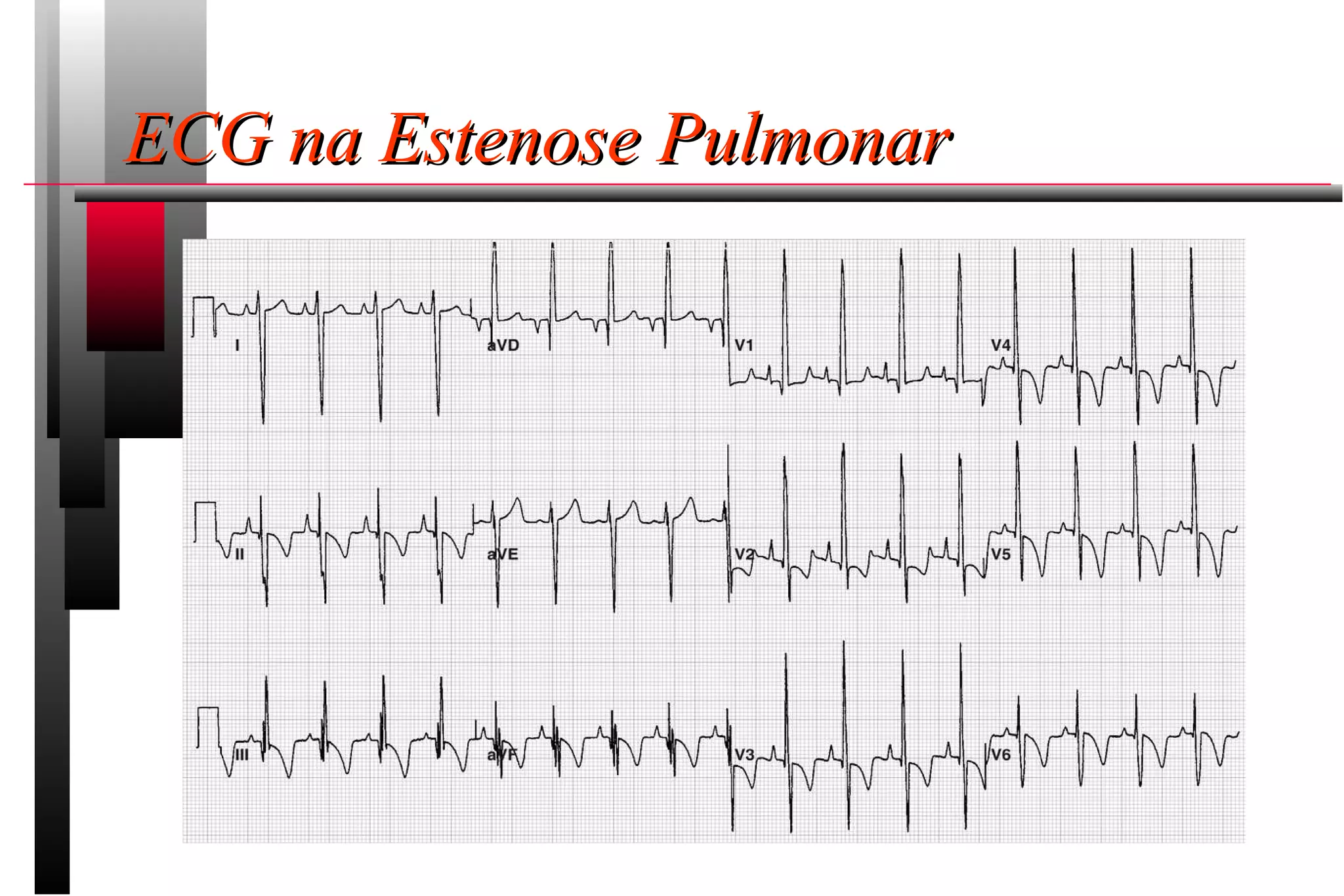 Coarctação da Aorta, Arco Aórtico interrompido e Estenose Pulmonar, | PPT