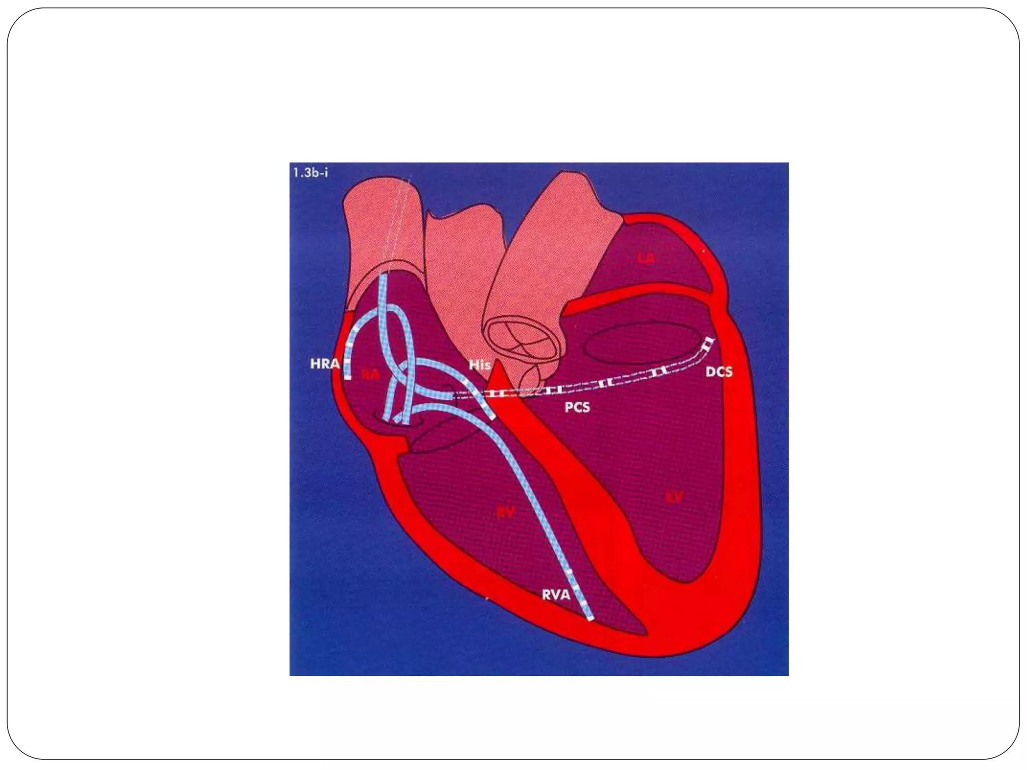 Ep diagnosis and ablation of avnrt | PPTX