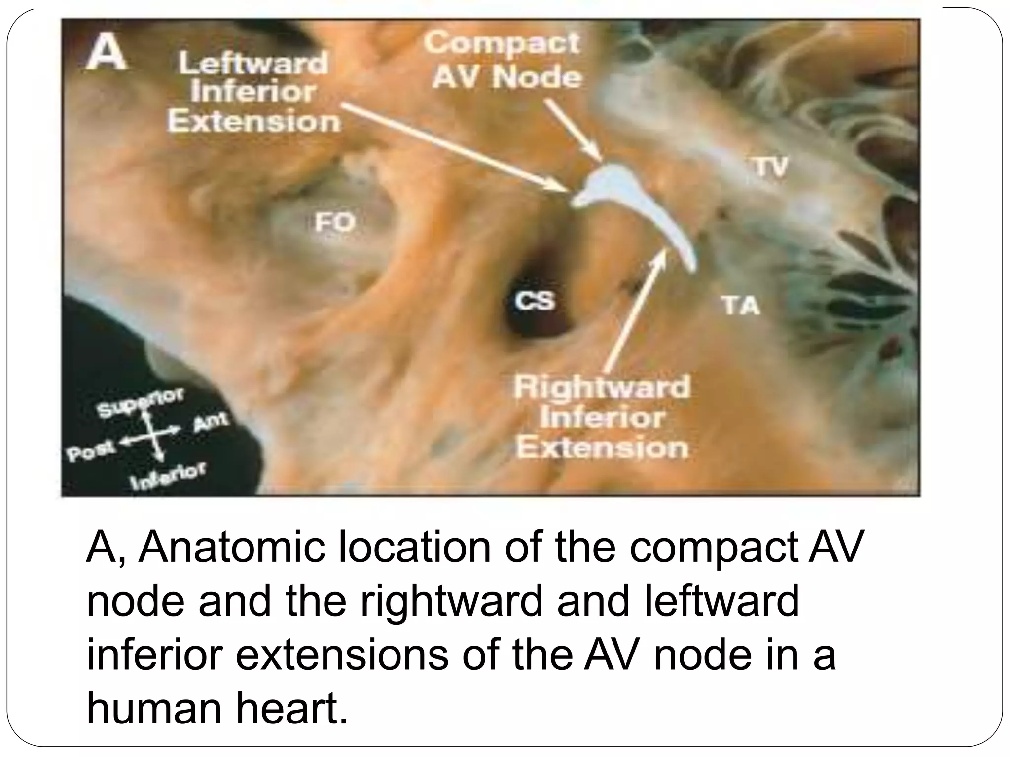 Ep diagnosis and ablation of avnrt | PPTX