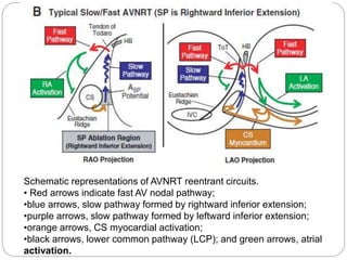 Ep diagnosis and ablation of avnrt | PPTX