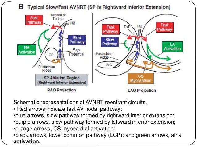 Ep diagnosis and ablation of avnrt