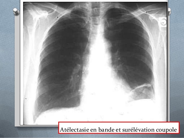 diagnostic de l 'embolie pulmonaire