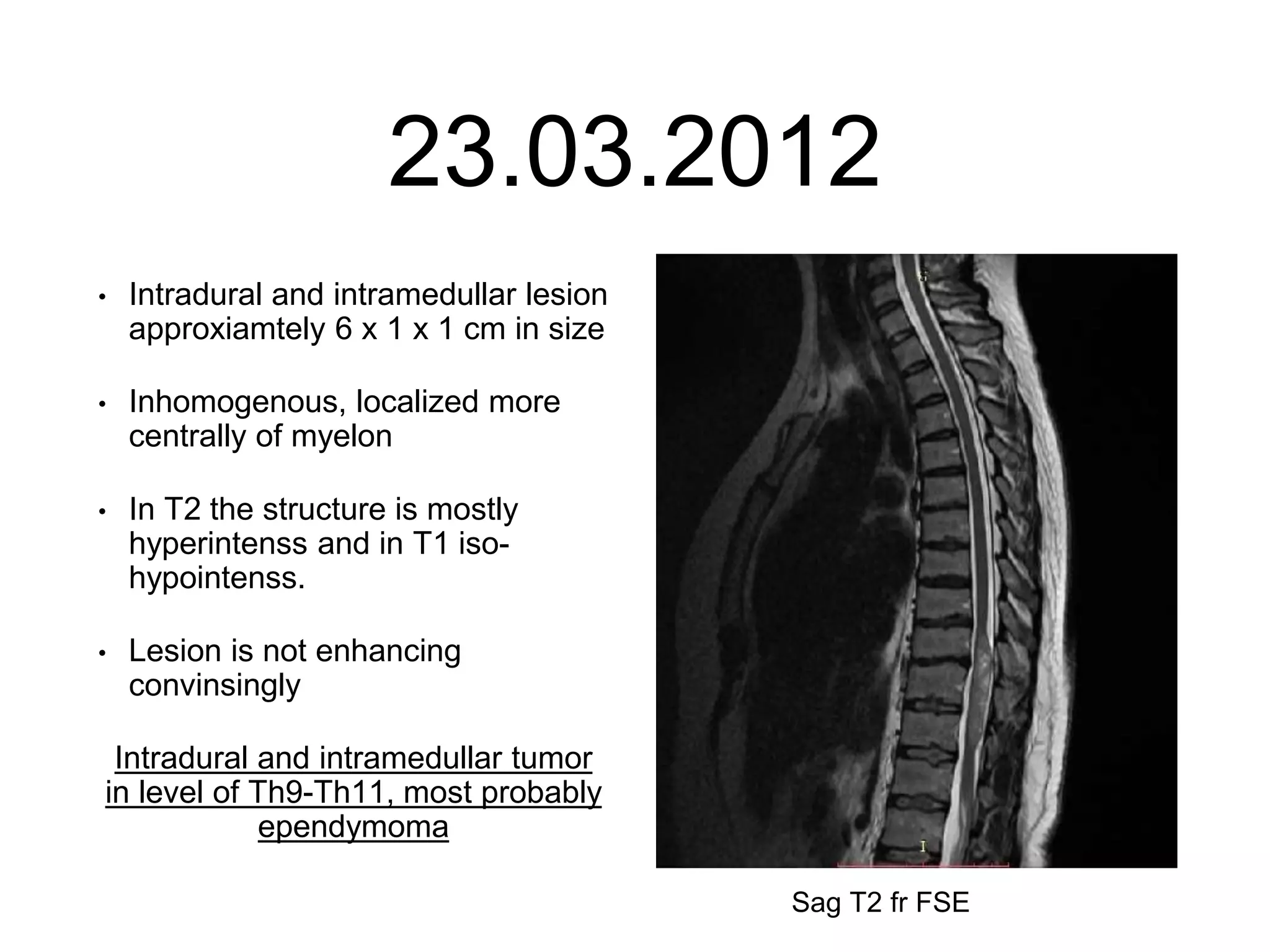 Ependymoma | PPTX