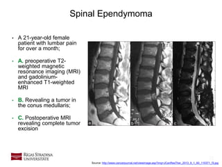 Ependymoma | PPTX