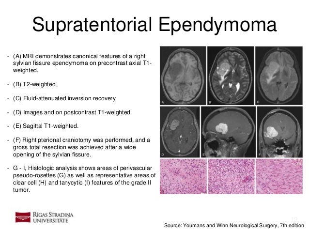 Ependymoma