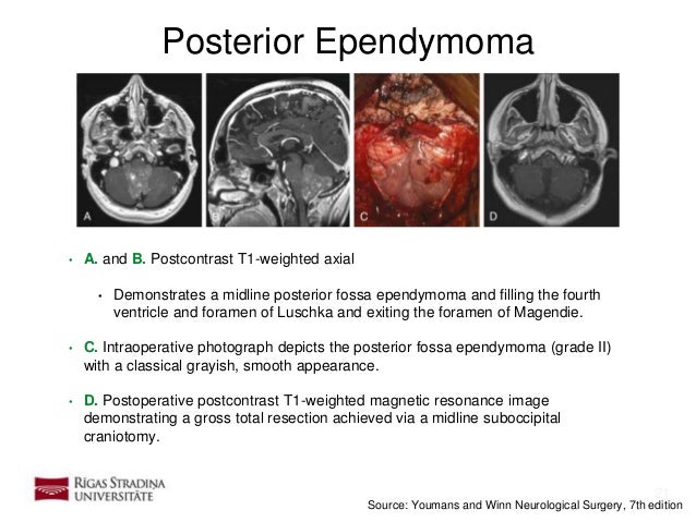 Ependymoma