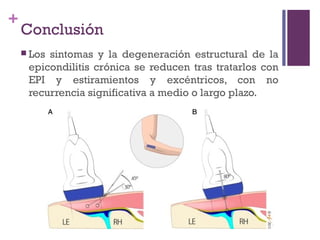 Electrolisis Percutánea Intratisular (EPI) en codo de tenista | PPT