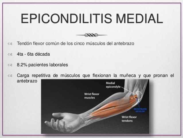 Epicondilitis medial y lateral - Tenosinovitis Quervain - Traumatolo…