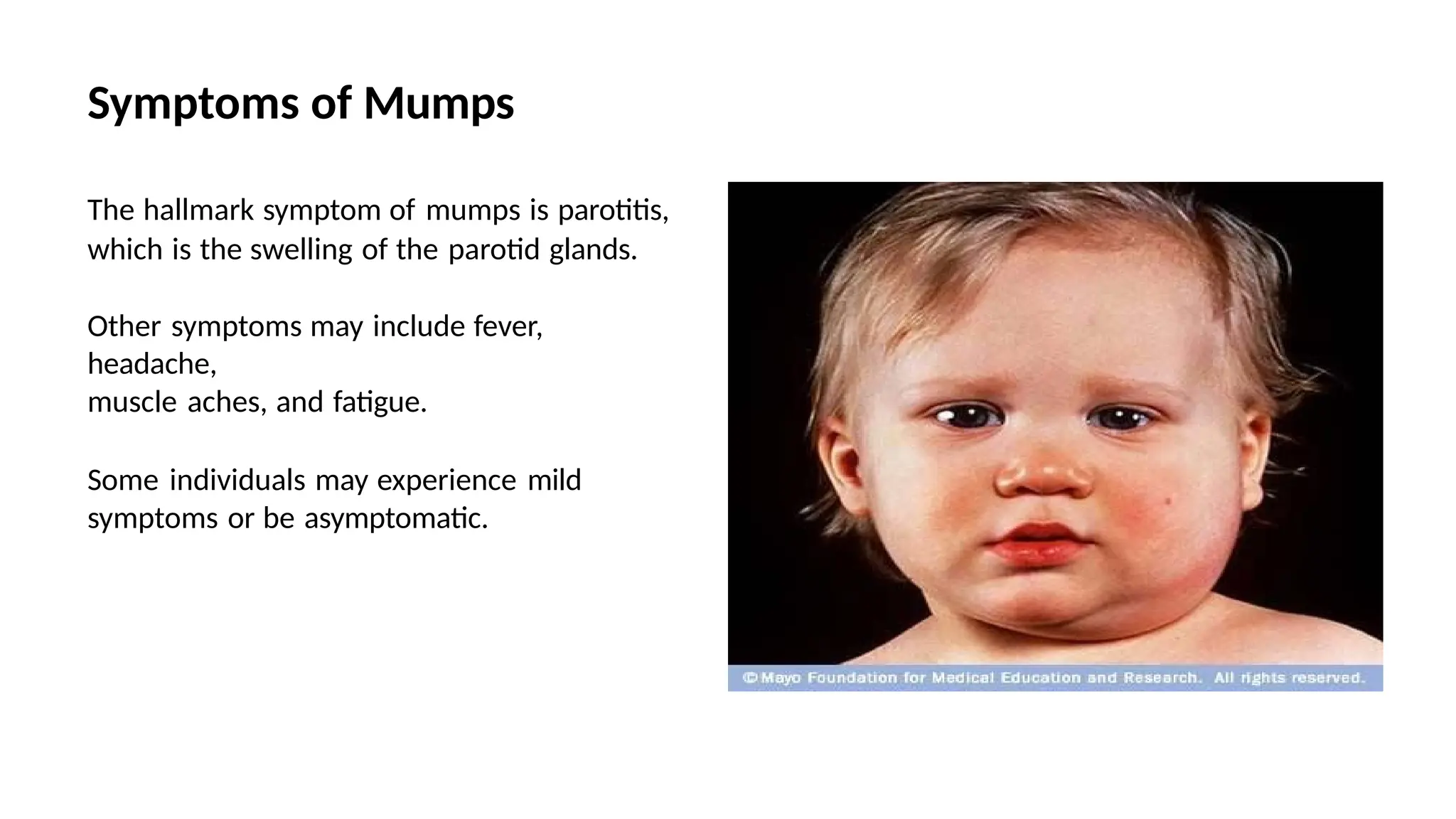Epidemic Parotitis (2) (1) boom boom2.pptx