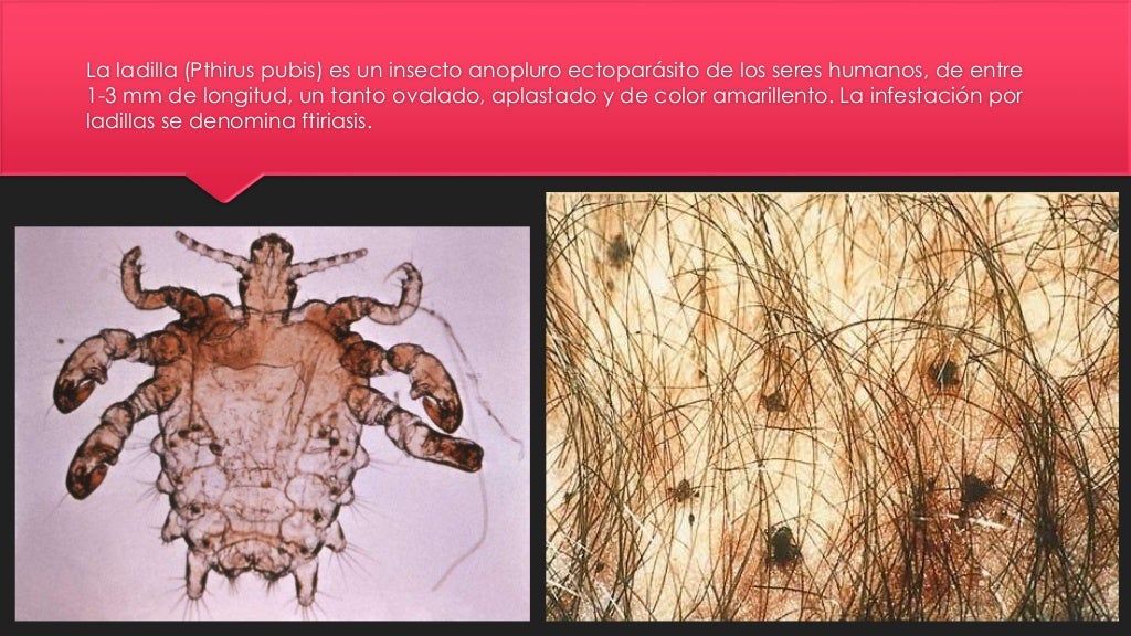 Ladilla Pthirus pubis