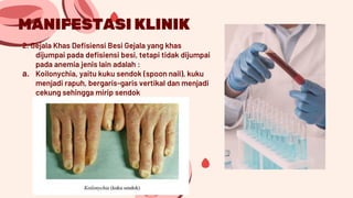 Epidemiologi Anemia Defisiensi Besi.pptx
