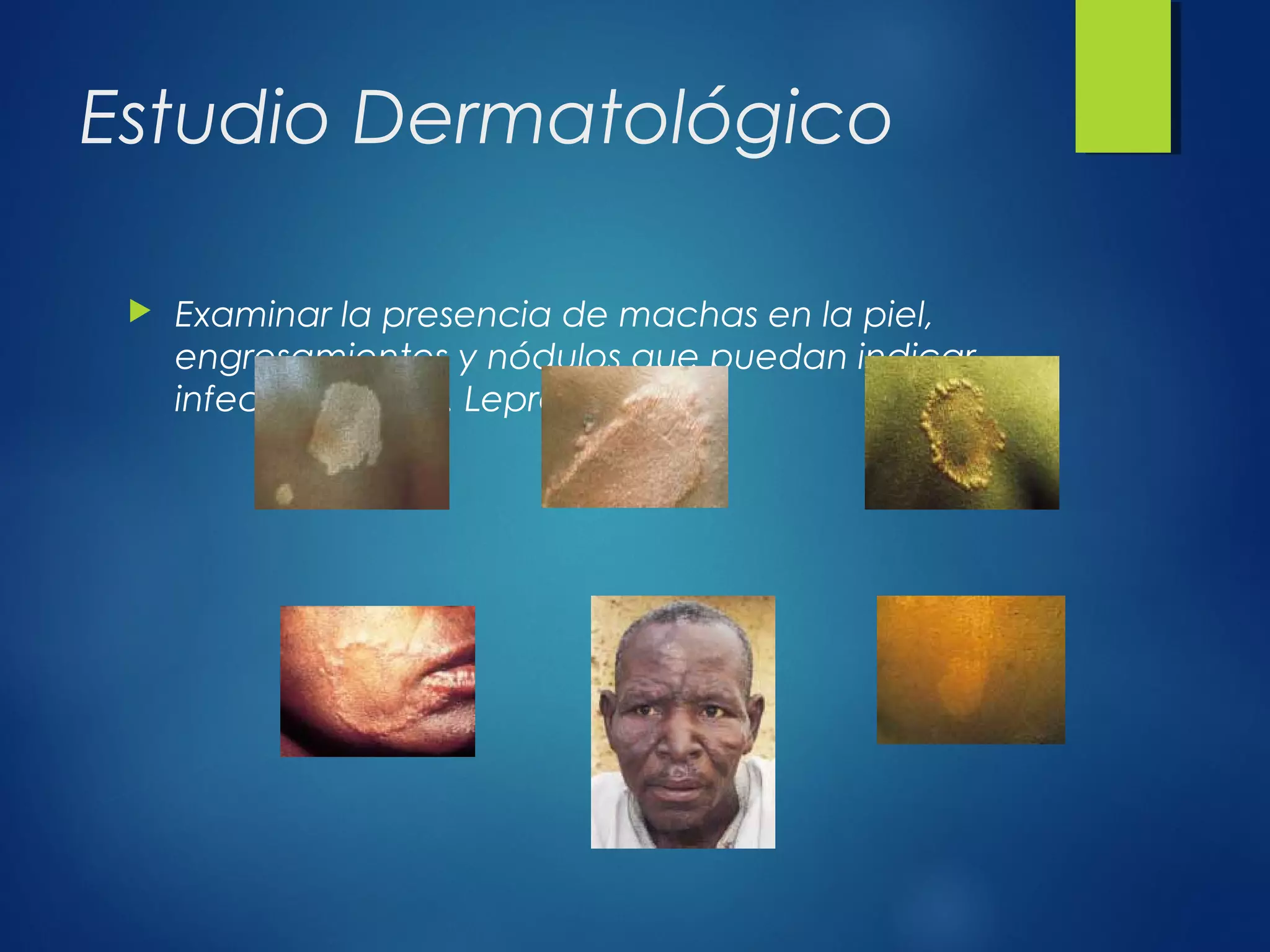 Epidemiologia y diagnostico de lepra | PPT
