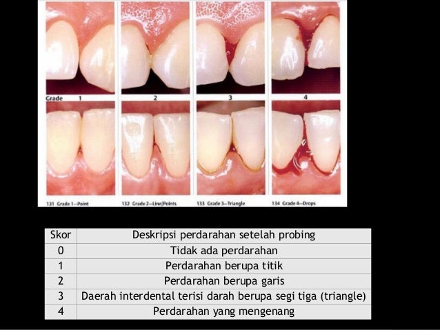 Epidemiologi penyakit gingiva dan periodontal