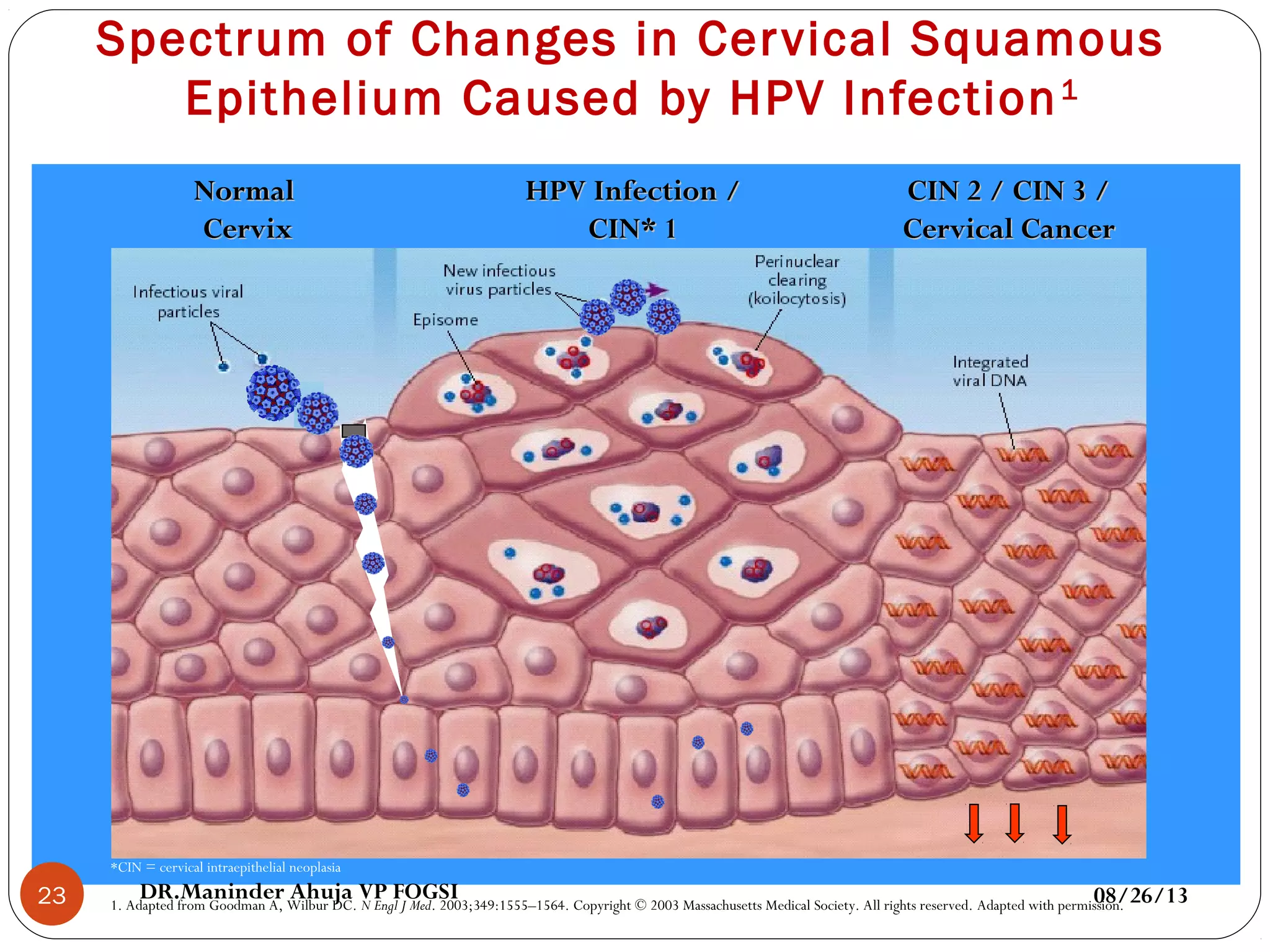Epidemiology and carcinogenesis of premalignant lesions of cervix | PPT