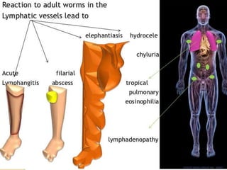 Elephantiasis Diagram