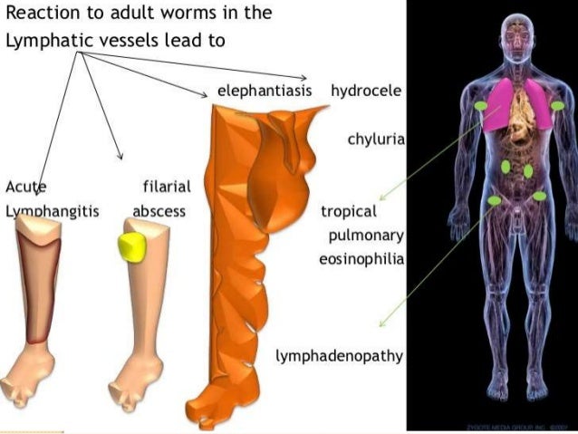 Epidemiology and control of filariasis (Lymphatic Filariasis) in India