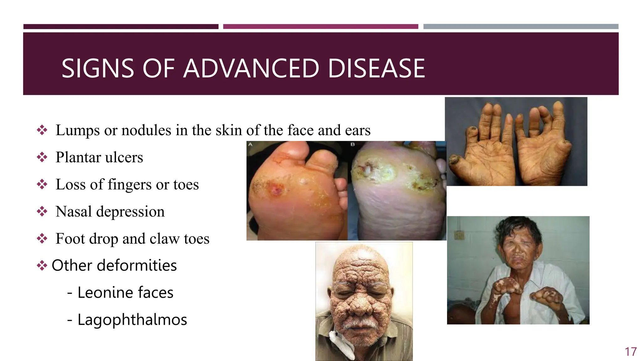 EPIDEMIOLOGY AND RECENT ADVANCES IN LEPROSY WITH NLEP - HARIMU.pptx