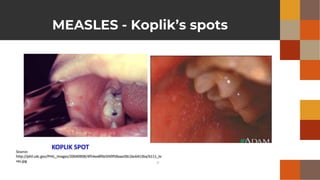 Epidemiology & Control Measures of Measles.pptx | Infectious Diseases ...