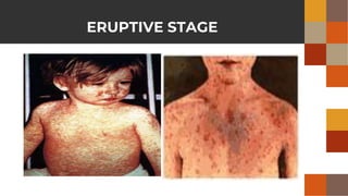 Epidemiology & Control Measures of Measles.pptx