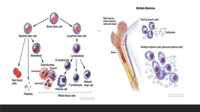 Epidemiology, Etiopathogenesis, Pathology, Staging of Plasma Cell ...