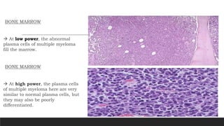 Epidemiology, Etiopathogenesis, Pathology, Staging of Plasma Cell ...