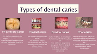 epidemiology of dental caries (1) (1).pptx