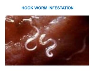 Epidemiology of hook worm infection.pptx