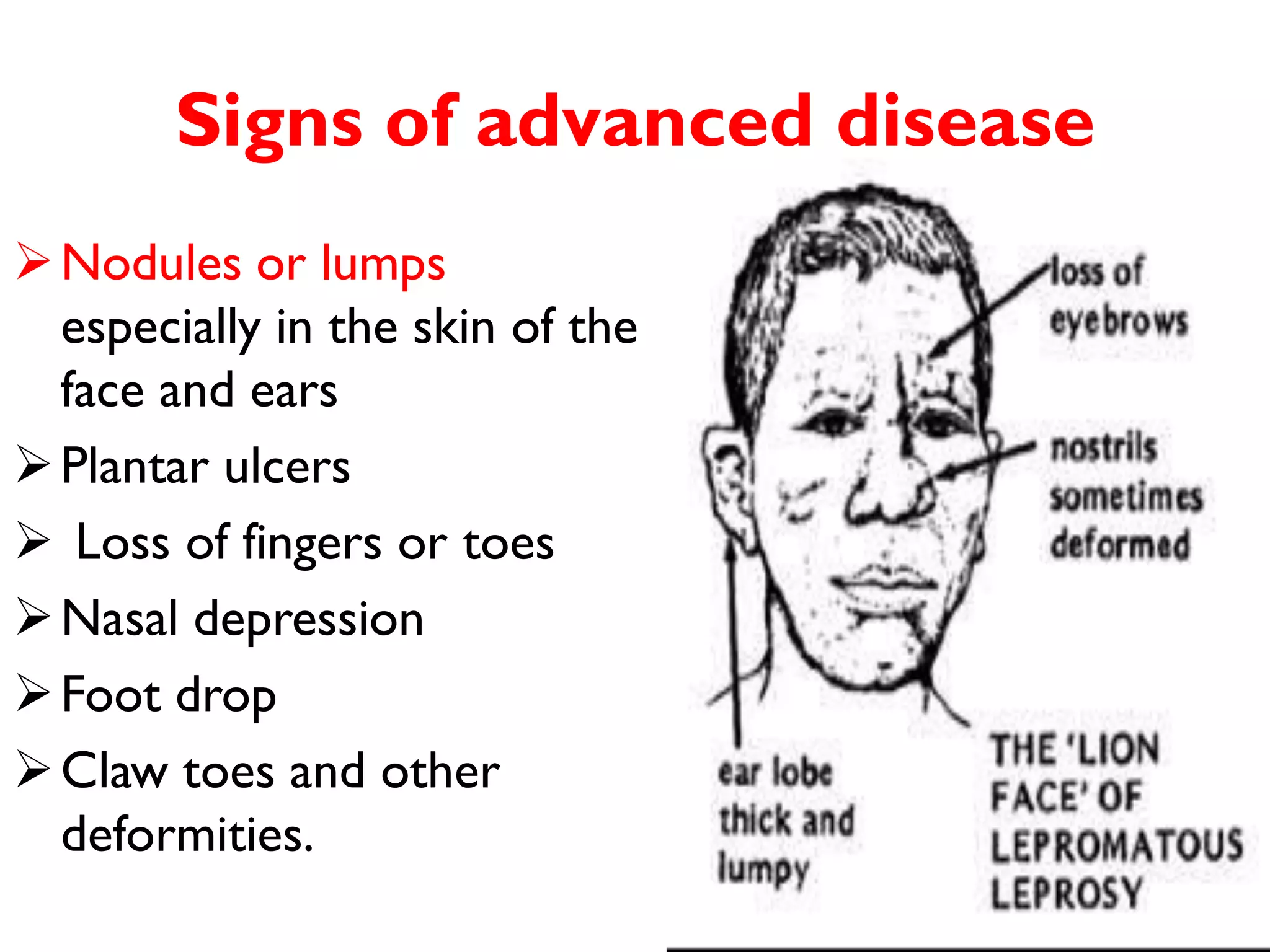 Epidemiology of leprosy | PDF