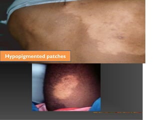 Epidemiology of leprosy | PDF