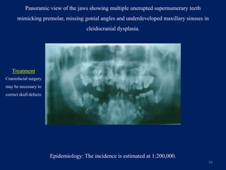 Epidemiology of malocclusion | PPTX