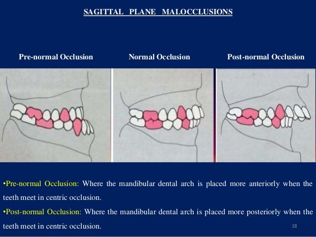 Epidemiology of malocclusion