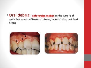 Epidemiology of periodontal disease ( main stream ) | PPT