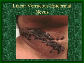 Epidermal Nevi, Neoplasms and Cysts – Part 1 Epidermal Nevi, Neoplasms ...