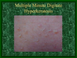 Multiple Minute Digitate Hyperkeratosis