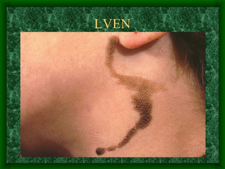 Epidermal Nevi, Neoplasms and Cysts – Part 1 Epidermal Nevi, Neopla…