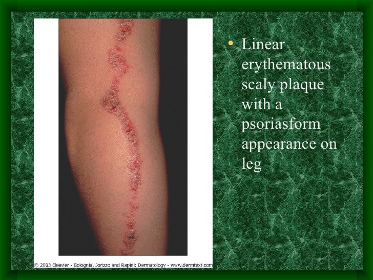 Epidermal Nevi, Neoplasms and Cysts – Part 1 Epidermal Nevi, Neopla…