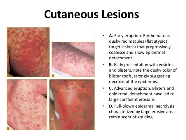 Epidermal necrolysis