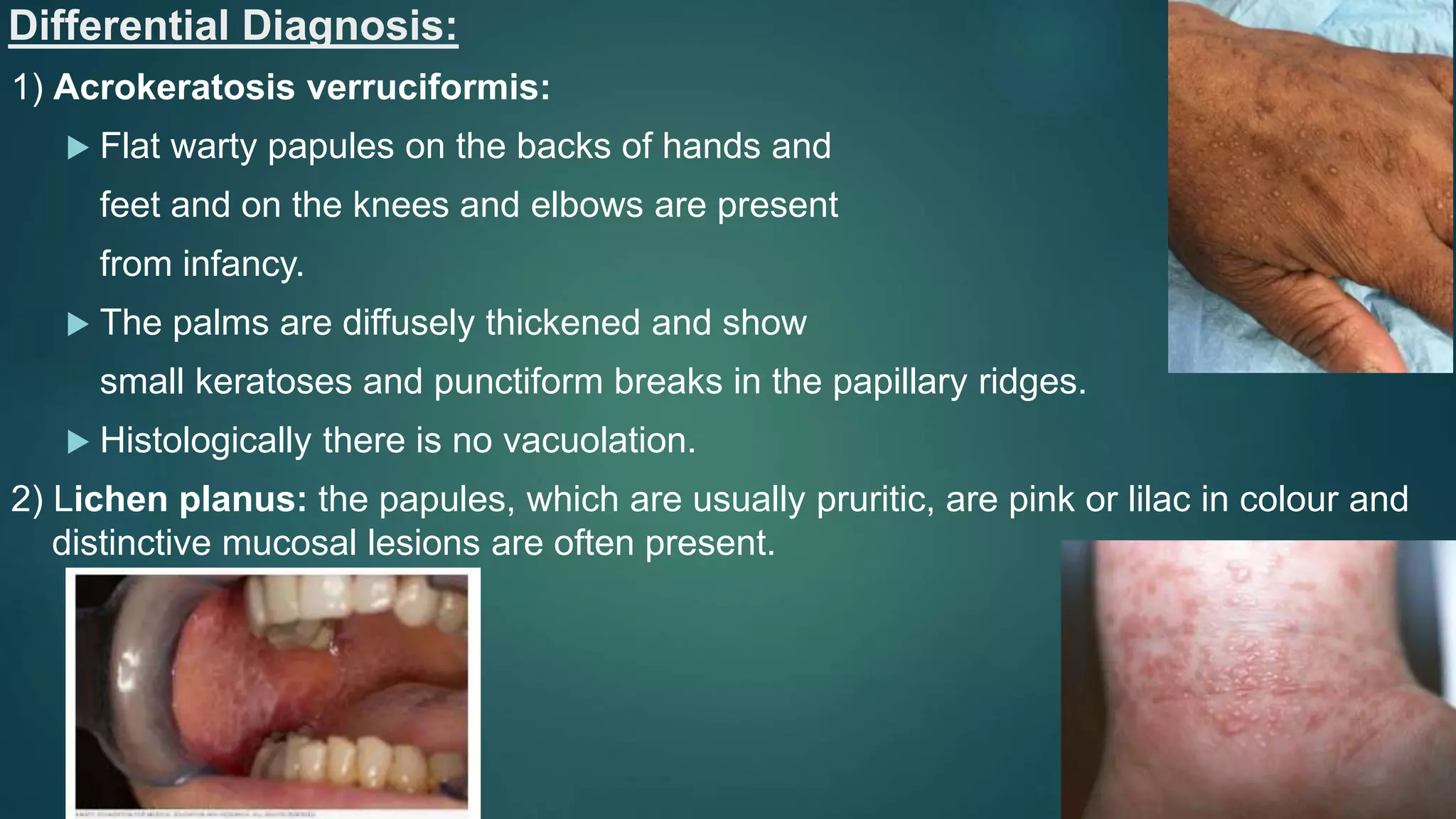 Epidermodysplasia verruciformis and HPV in Immunocompromised | PPTX