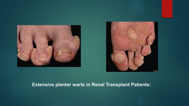 Epidermodysplasia verruciformis and HPV in Immunocompromised | PPT