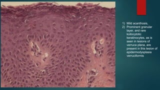 Epidermodysplasia verruciformis and HPV in Immunocompromised | PPT